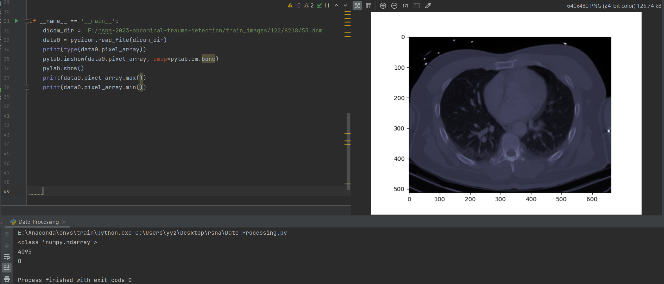 RSNA 2023 腹部创伤检测 分割数据集预处理部分 | Scorpio-yyz